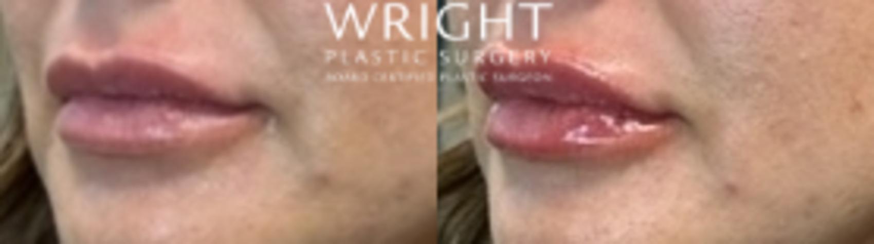 Dermal Filler Before and After Pictures Case 384 | Little Rock ...