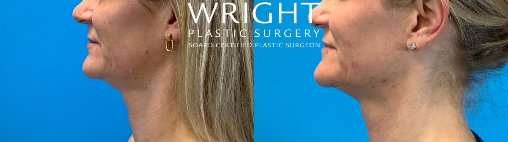 ellacor® Micro-Coring Before and After Pictures Case 328 | Little Rock ...