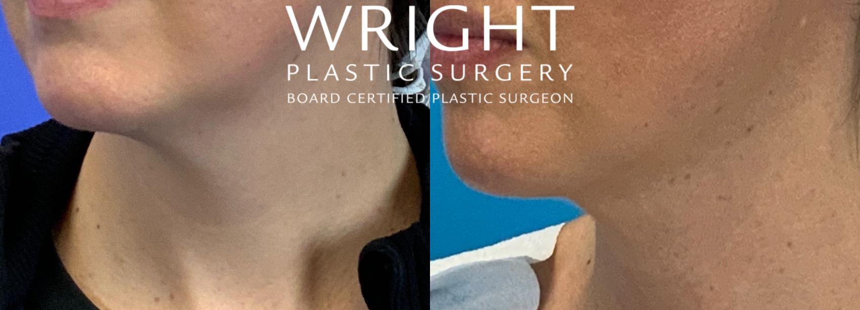 Renuvion Before and After Pictures Case 179 | Little Rock, Arkansas ...