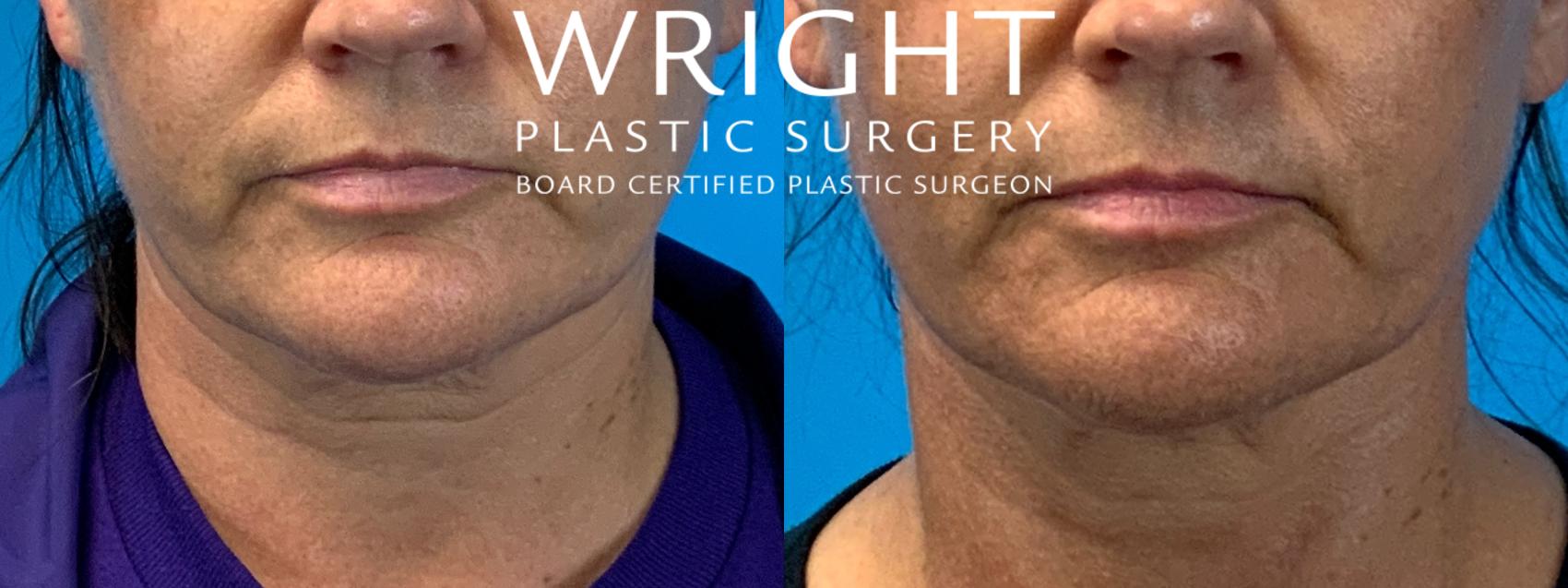 Renuvion Before and After Pictures Case 310 | Little Rock, Arkansas ...