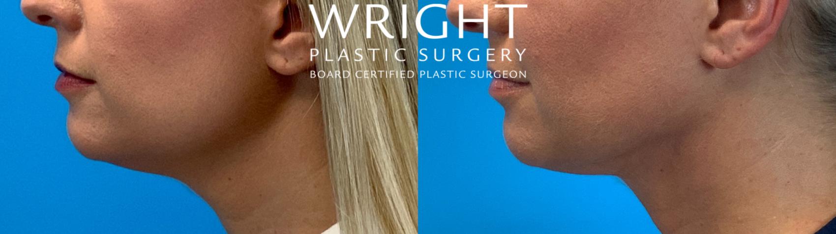 Renuvion Before and After Pictures Case 360 | Little Rock, Arkansas ...